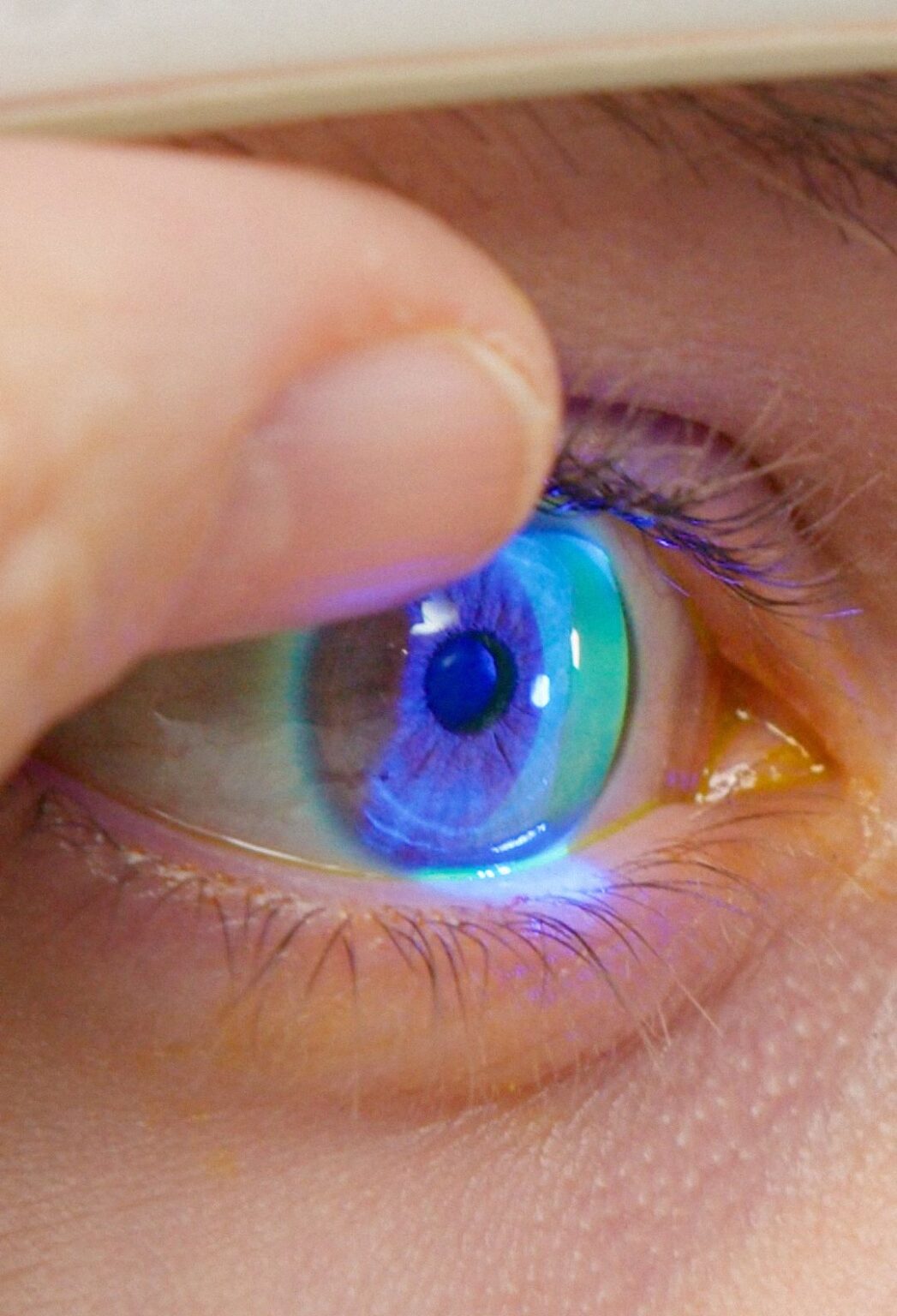 Conjunctivitis Treatment In Dubai - Prevention & Treatment FAQs